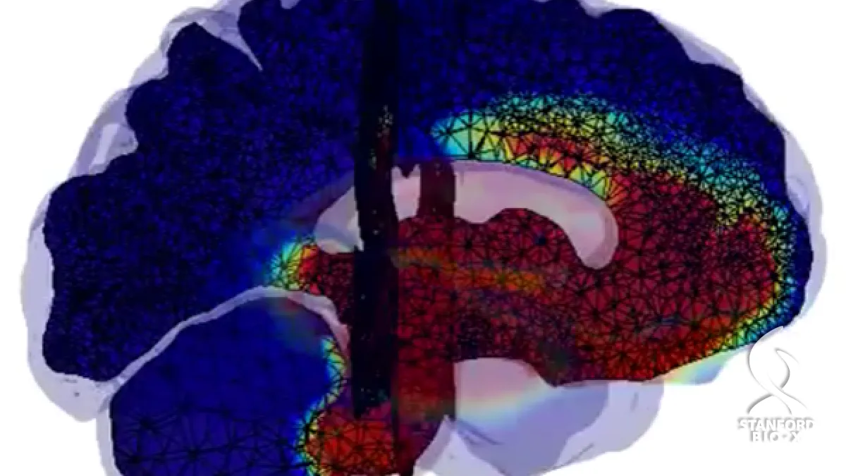 Stanford-led team simulates how Alzheimer’s disease spreads through the ...