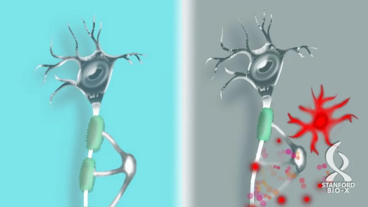 CAR-T cell therapy for cancer causes ‘brain fog,’ Stanford Medicine-led ...