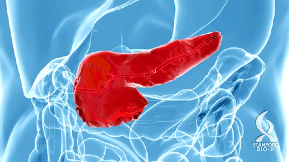 Pancreatic cancer, diabetes link explored by Stanford researchers ...