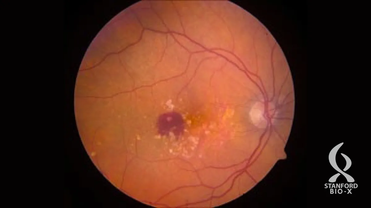 Retinal-scan analysis can predict advance of macular degeneration ...